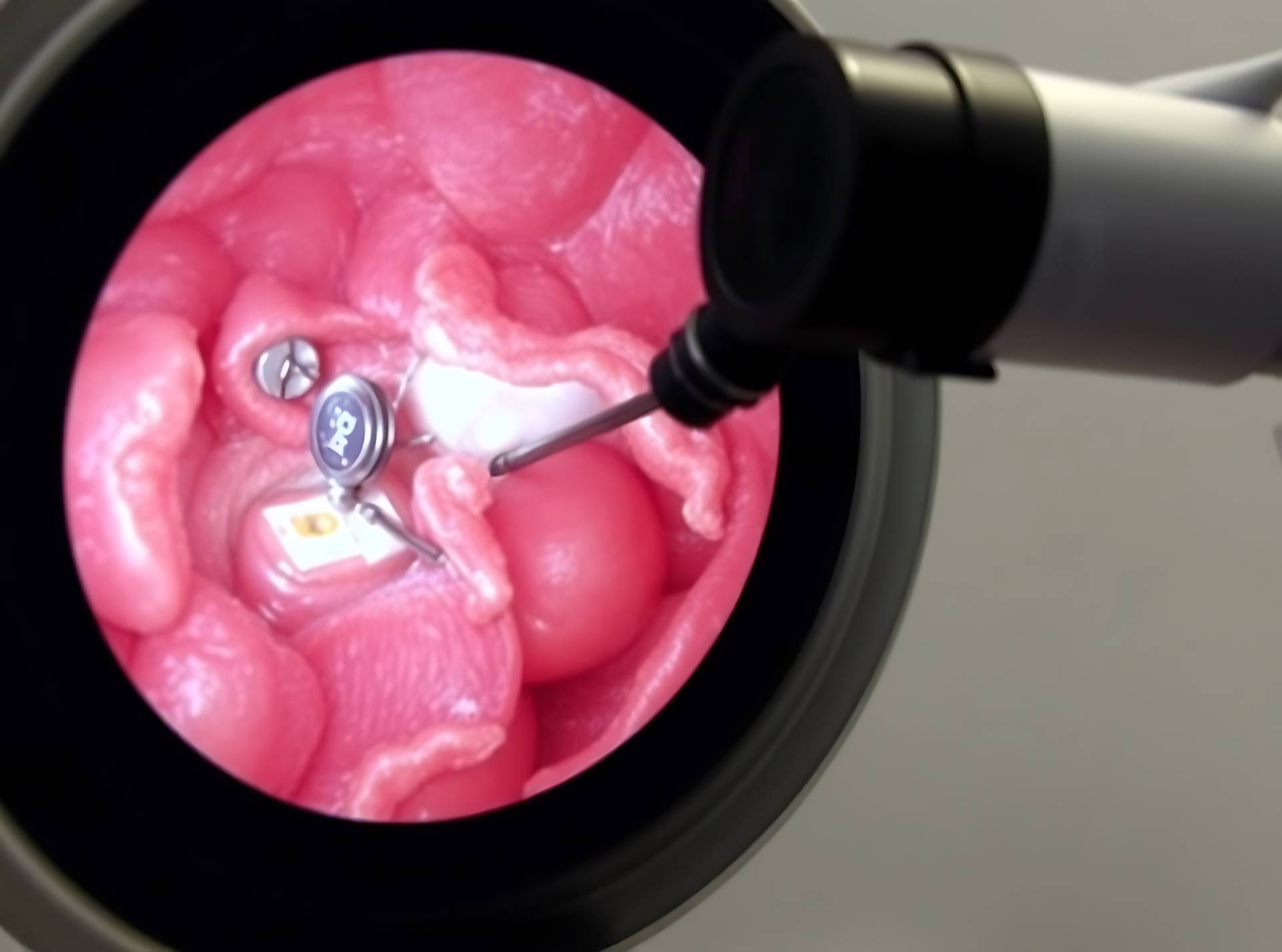 Endoscopic Mucosal Resection in Louisiana